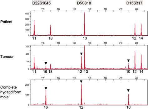 Short Tandem Repeat Genotyping Of The Patient Her Tumor And Complete Download Scientific