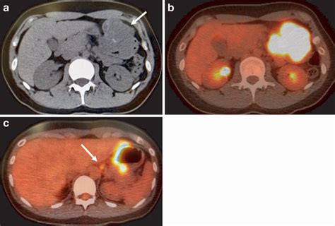 A Ct Showing A Giant Phyllodes Tumor With Calcification In The