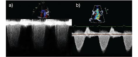 Continuous Wave Doppler Incomplete Parabolic Doppler Signal In Mild