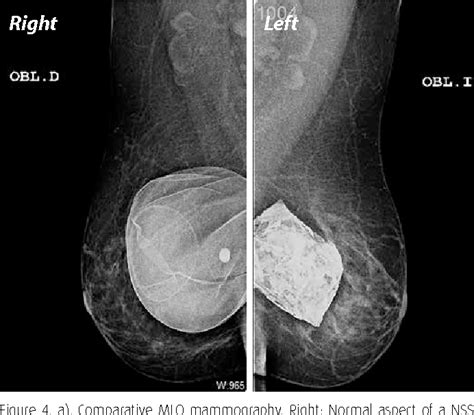 Figure 9 From Breast Implants Adverse Events And Rare Complications