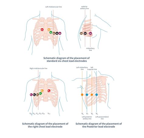 Ecg Electrode Design At Evie Rounsevell Blog