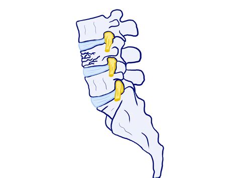 Vertebral Fracture Dr Thomas Robert