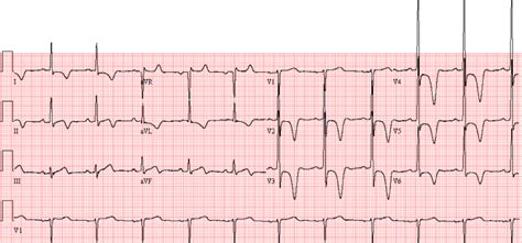 Apical Hypertrophic Cardiomyopathy Archives Ecg Made Simple