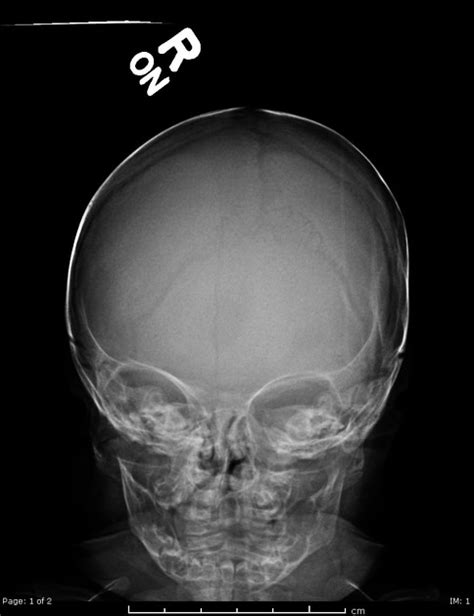 Lambdoid Suture X Ray