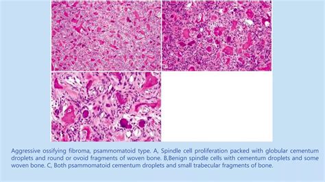 Central Ossifying Fibroma Pptx
