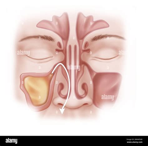 Maxillary Sinuses Diagram External Approaches To The Paranasal Sinuses