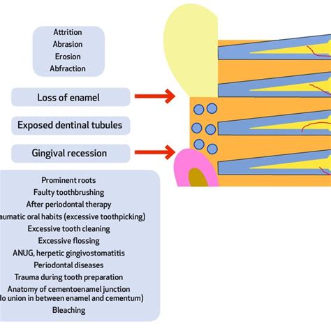 Etiology And Predisposing Factors For Dentinal Hypersensitivity