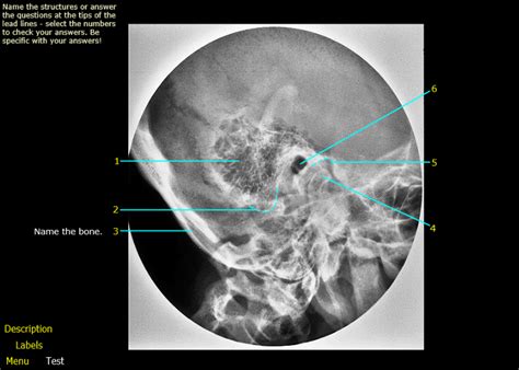Temporal Bone Mastoid Air Cells 6 Diagram Quizlet