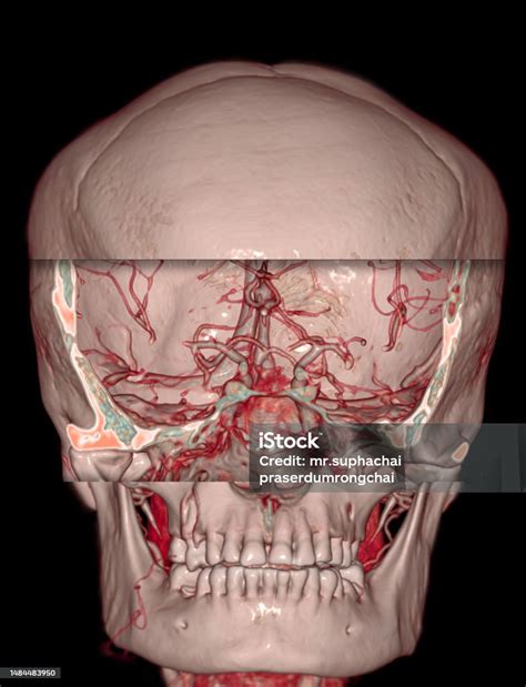 Cta 뇌 및 경동맥 또는 뇌의 Ct 혈관 조영술 3d 렌더링 이미지 0명에 대한 스톡 사진 및 기타 이미지 0명 Cat 스캔 Cat 스캔 기계 Istock
