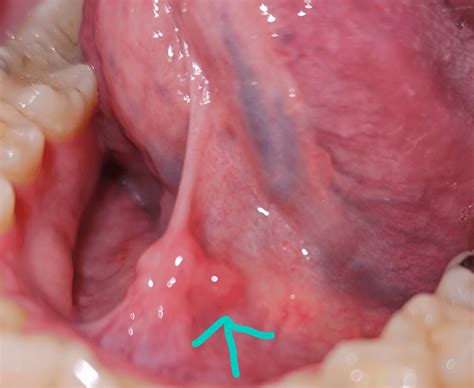 Hard Lump Under Tongue Fimbriated Fold Of Tongue Wikipedia