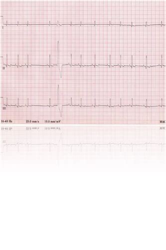 Cardiology 3 Dcm Arvc Hcm Flashcards Quizlet