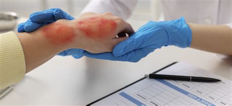 How To Identify And Treat Burns Effectively
