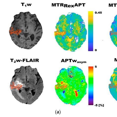 Exemplary Contrast Maps Of Two Participants With Larger Hemosiderin Download Scientific Diagram