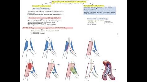 Coronary Bifurcation Stenting Modern Algorithms And Details Of Provisional Techniques Elias