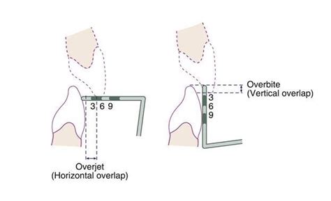 Orthodontics Comparison Of Overjet And Overbite Facebook