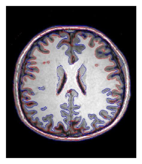 Segmentation For Brain Mris By The Active Contour Methods Based On
