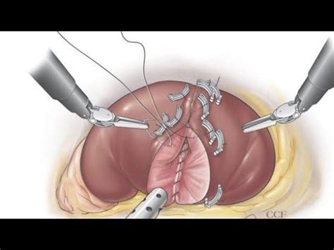 Dr Aditya Sharma On Linkedin Laparoscopic Partial Nephrectomy For Left Side Lower Pole Tumor