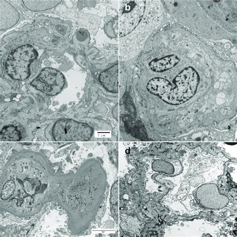 additional electron microscopy findings showing features of tma a