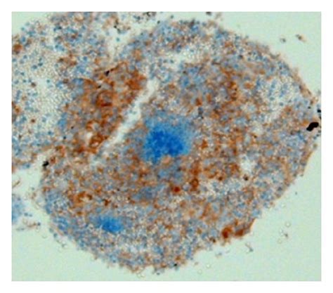 Endoscopic Ultrasonography Demonstrated An Enlarged Perigastric Lymph