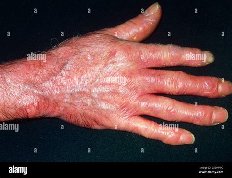 Scleroderma Red Thickened And Tough Looking Skin On The Hand Of A 52 Year Old Man With
