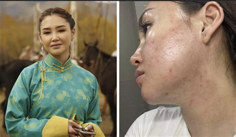 “Хөөрхөн” Б Мишээл арьсны асуудалтай байснаа нуусангүй Tac Mn