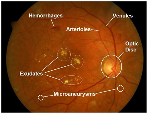 Localization And Segmentation Of Optic Disc In Retinal Images Using Circular Hough Transform And