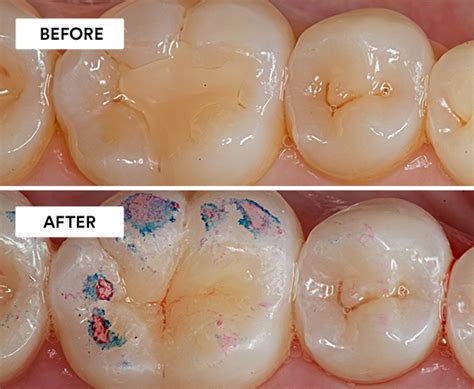 Clinical Case Bulk Fill Composite In Class I 3m Dental Blog