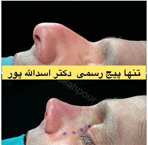 بینی‌ای زیبا و طبیعی هدیه‌ای برای خودتان کلینیک زیبایی بینی اسدالله