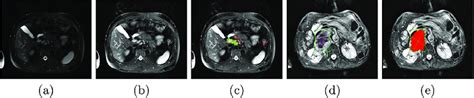 A A T2 MRI Image And B Its Normalized And Histogram Equalized