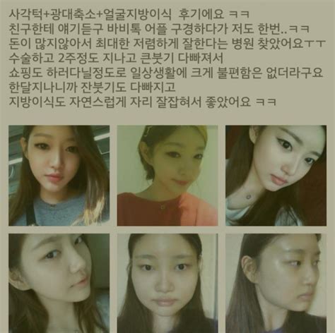 여자들 성형수술 후기 인스티즈instiz 이슈 카테고리