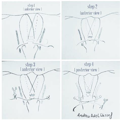 Pdf Uterine Salvage Management For Atonic Postpartum Hemorrhage Using “modified Lynch Suture”