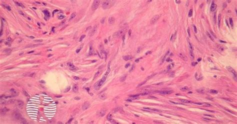 Dermatofibrosarcoma Protuberans Pathology Image