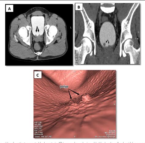 Figure 1 From The Role Of Multidetector Ct Virtual Cystoscopy Compared