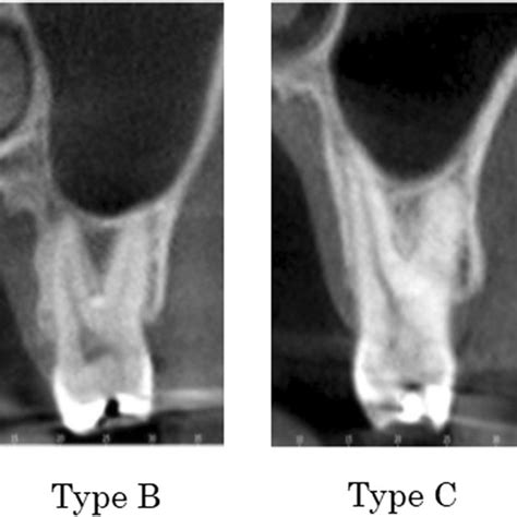 Archer Third Molar Classification 8 1 Mesioangular 2