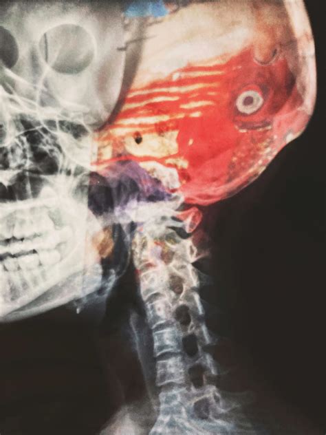 Computed Tomography Ct Reconstruction Algorithms Enhancing Image