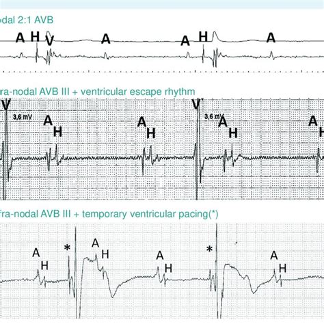Examples Of Sinus Rhythm With Nodal Top Panel And Infra Nodal Block