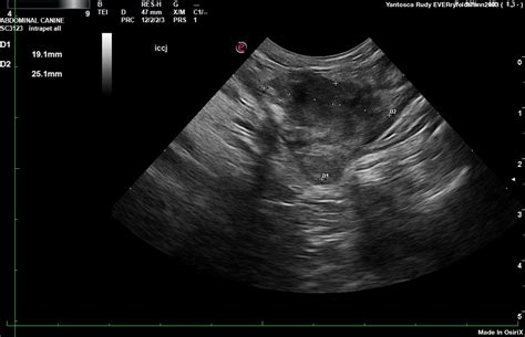Ileocecal Mass In A 14 Year Old Mn Dsh Members