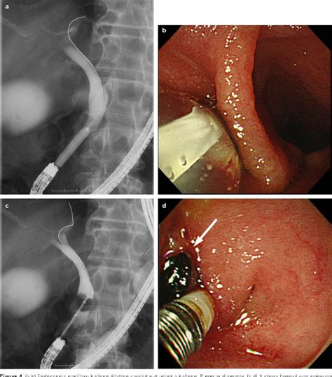 Figure 4 From How To Perform Balloon Assisted Enteroscopic Ercp