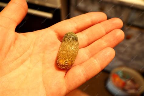 Premium Photo Gallstone Disease Cholelithiasis The Formation Of