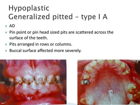 Developmental Disturbances In Structure Of Teeth Pptx
