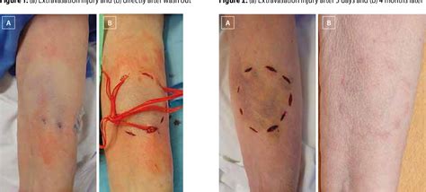 Extravasation Of Intravenous Fluid In A Preterm Neonate