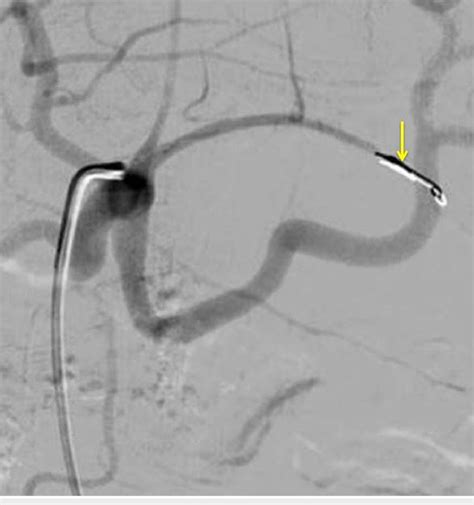 Coil Embolization Pelvic Pain At Marcus Hanger Blog