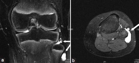 Ganglion Cyst Proximal Tibiofibular Articulation