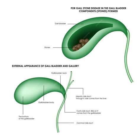 Gallbladder Infundibulum
