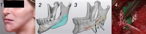 Figure 4 From Reconstruction Of Craniomaxillofacial Bone Defects With 3d Printed Bioceramic