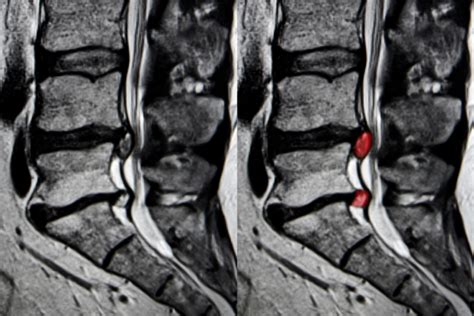 All About Sciatica From A Herniated Disc Advanced Ortho And Spine