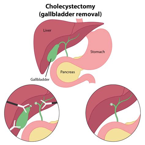 Gallbladder Surgery Savannah Robotic Surgeon Dr T Ellis Barnes