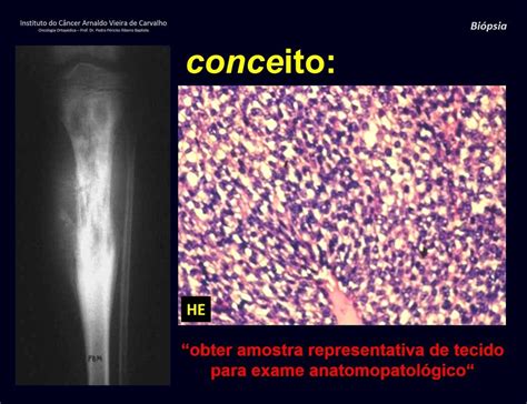Biópsia Conceito Tipos Indicações Planejamento