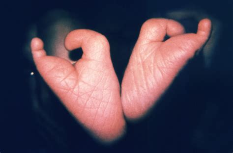 Ankyloblepharon Ectodermal Defects Cleft Lip Palate Syndrome