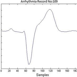 Left Bundle Branch Block Download Scientific Diagram